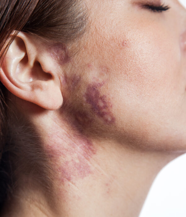 Port Wine Stains | Dermace Laser & Skin Clinic